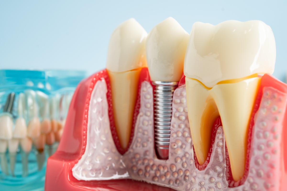 Root Canal vs Extraction: The Best Long-Term Choice